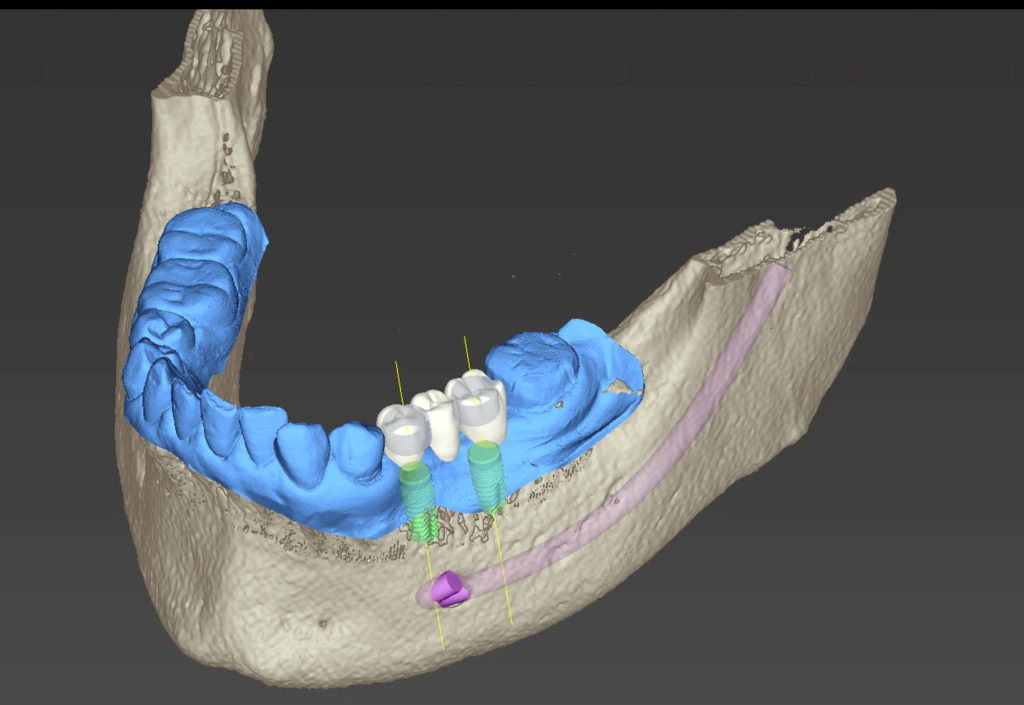 New Dimensions: How CT Scans Revolutionize Implant Procedures – 20/20 ...